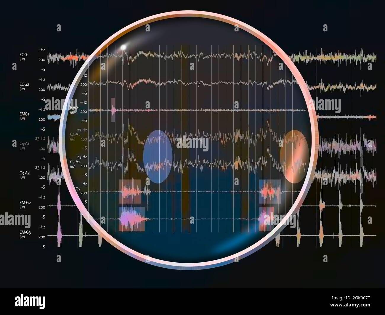 Restless legs syndrome (polysomnography): tingling of the legs Stock ...
