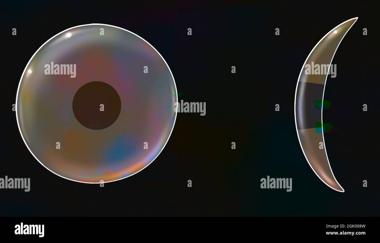 Correction of presbyopia: concentric alternating vision contact lens ...