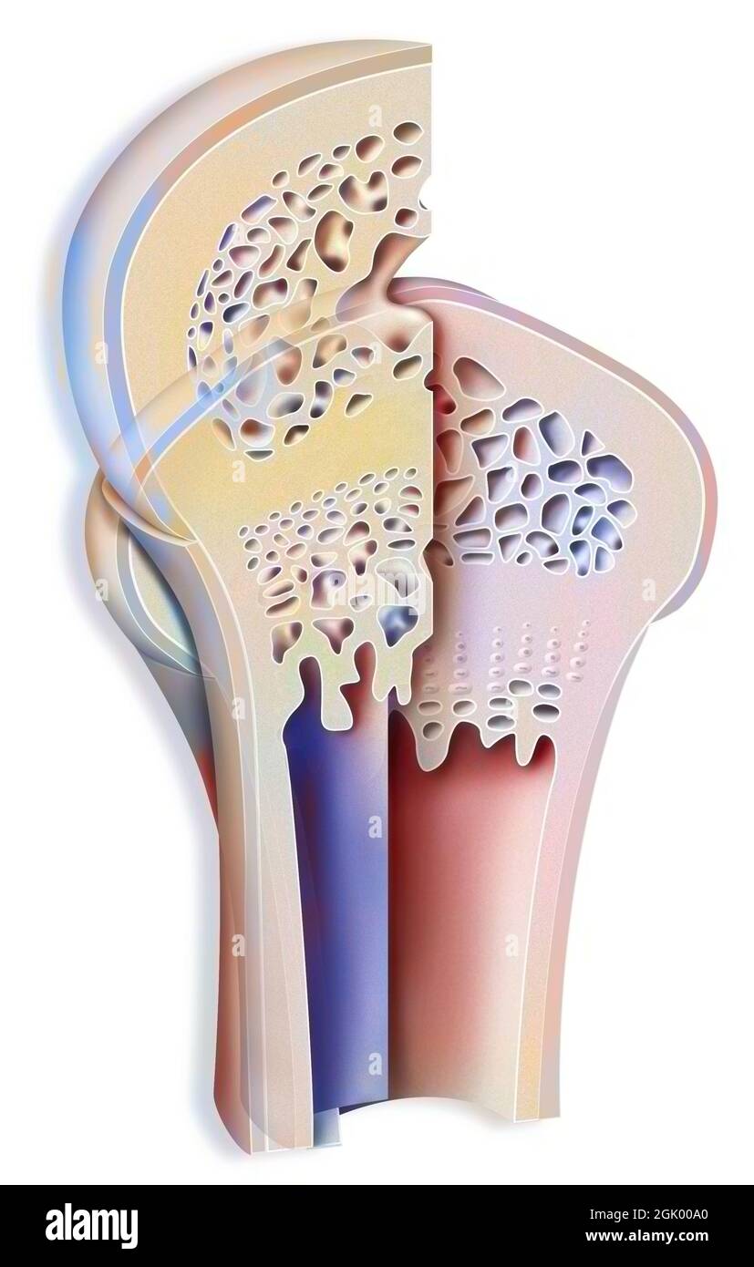 Development of long bone: the epiphysis widens and grows, and the head ...