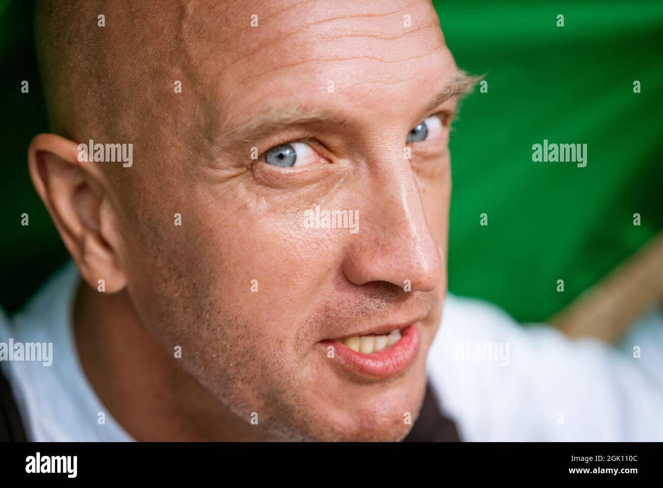 Alopecia Areata Eyebrows