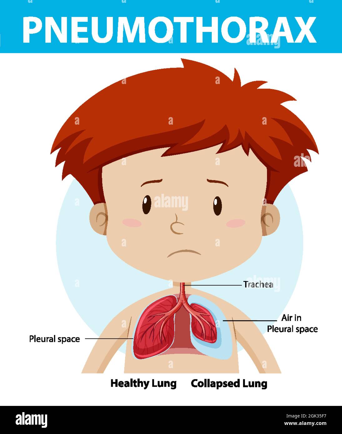 Pneumothorax diagram of human anatomy illustration Stock Vector Image ...