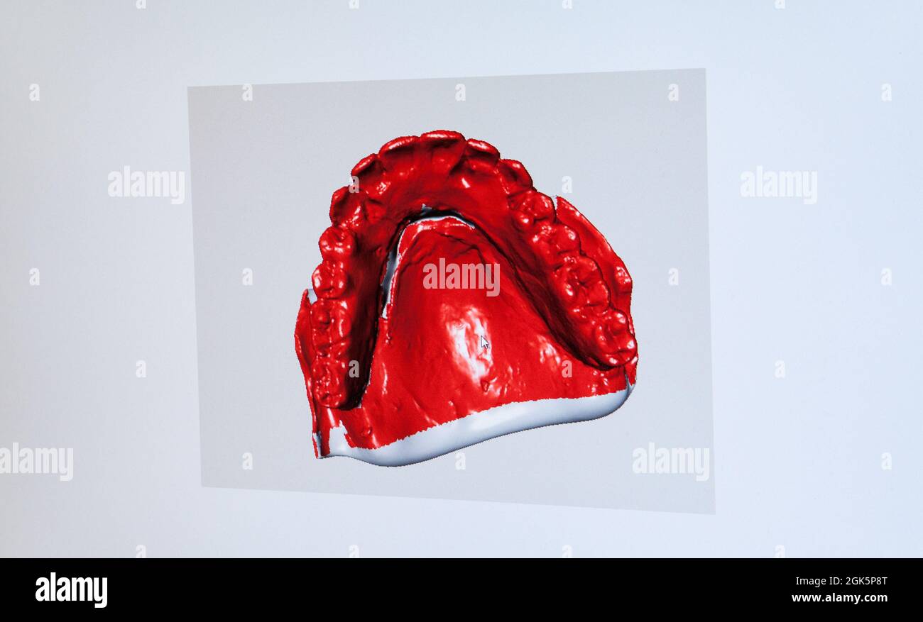 Dental prostheses and Computer Aided Design Manufacturing system from a ...