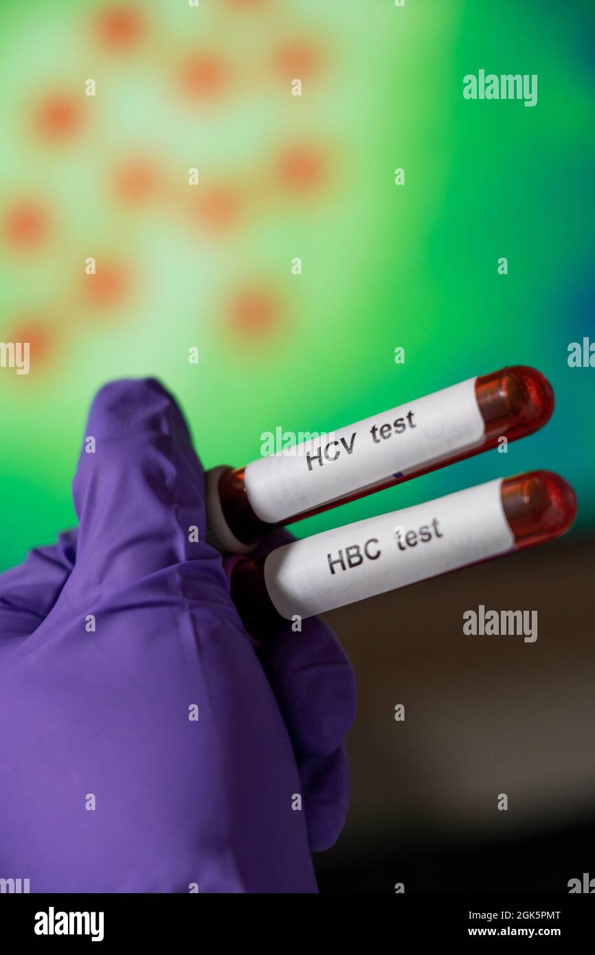 Blood tests for hepatitis B (HBC) and C (HCV Stock Photo - Alamy