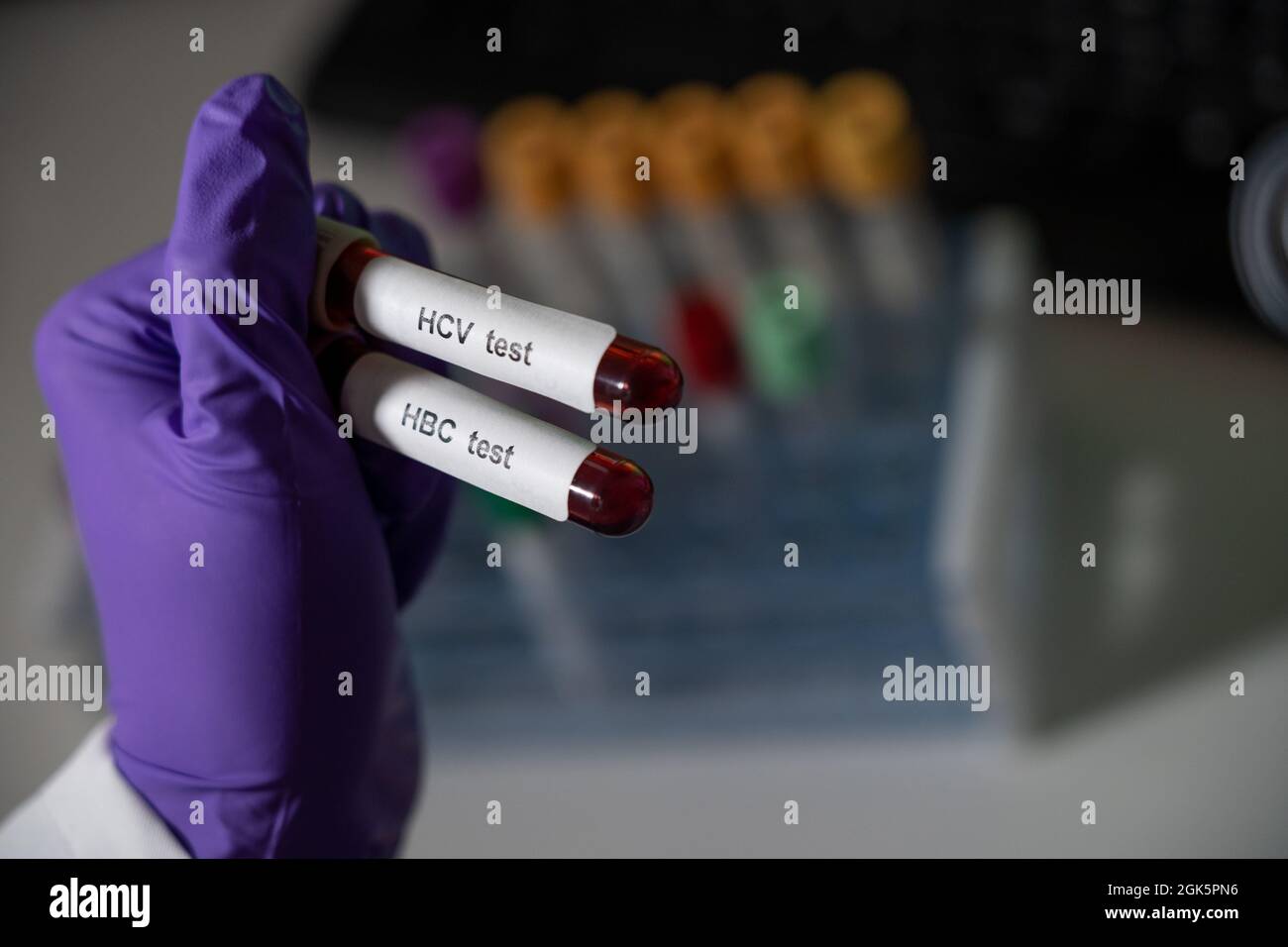 Blood tests for hepatitis B (HBC) and C (HCV Stock Photo - Alamy