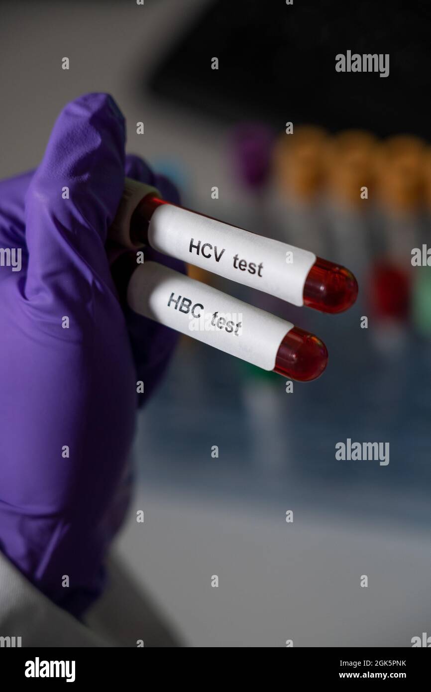 Blood tests for hepatitis B (HBC) and C (HCV Stock Photo - Alamy