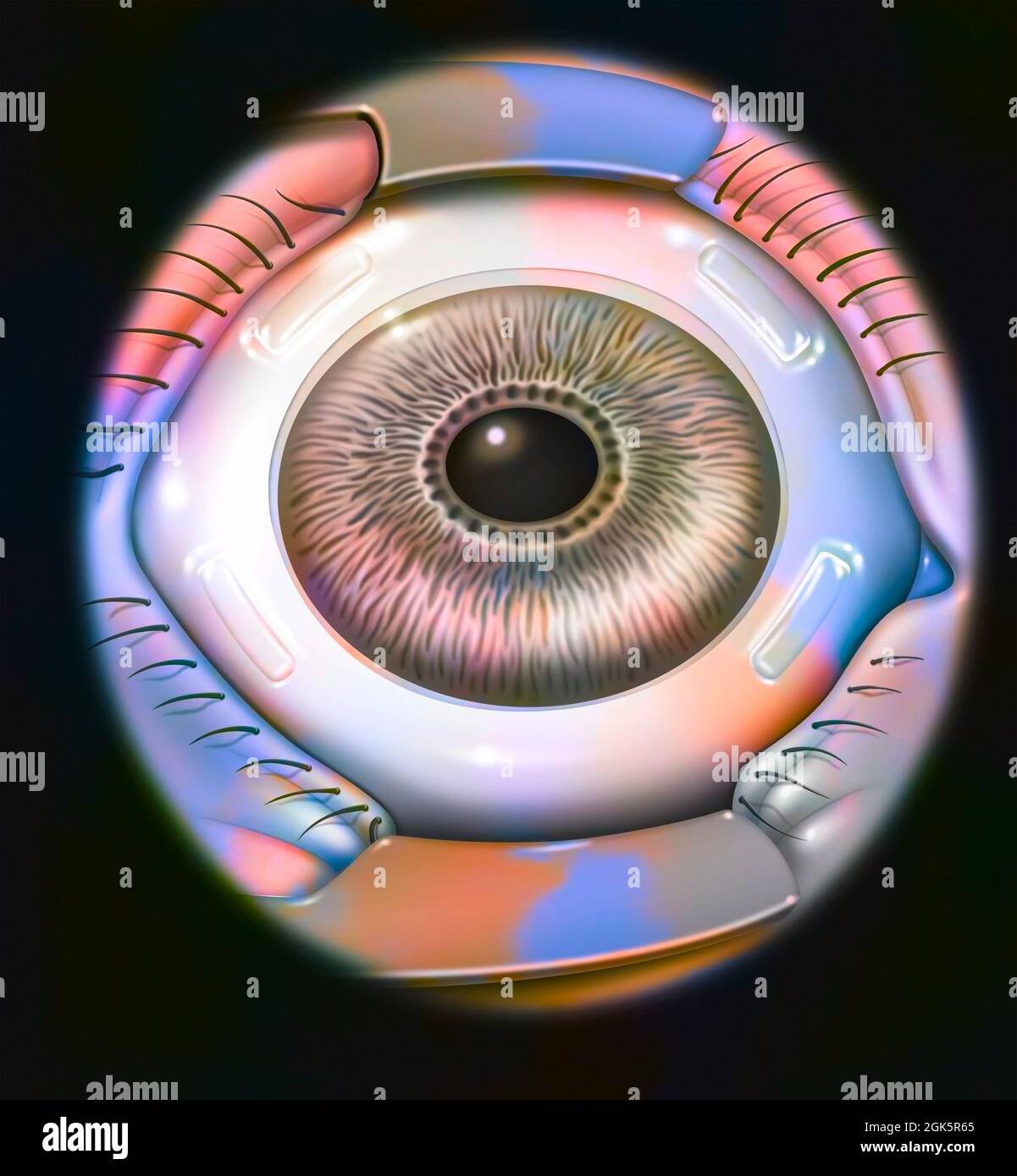 Eye, refractive surgery: treatment of presbyopia by scleral expansion ...