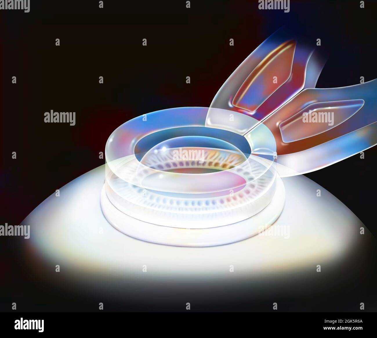 Eye (refractive surgery), Lasik: Suction ring for femtosecond laser ...