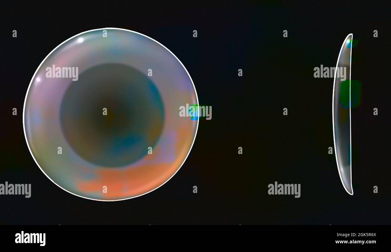 Correction of presbyopia: concentric simultaneous vision contact lens ...