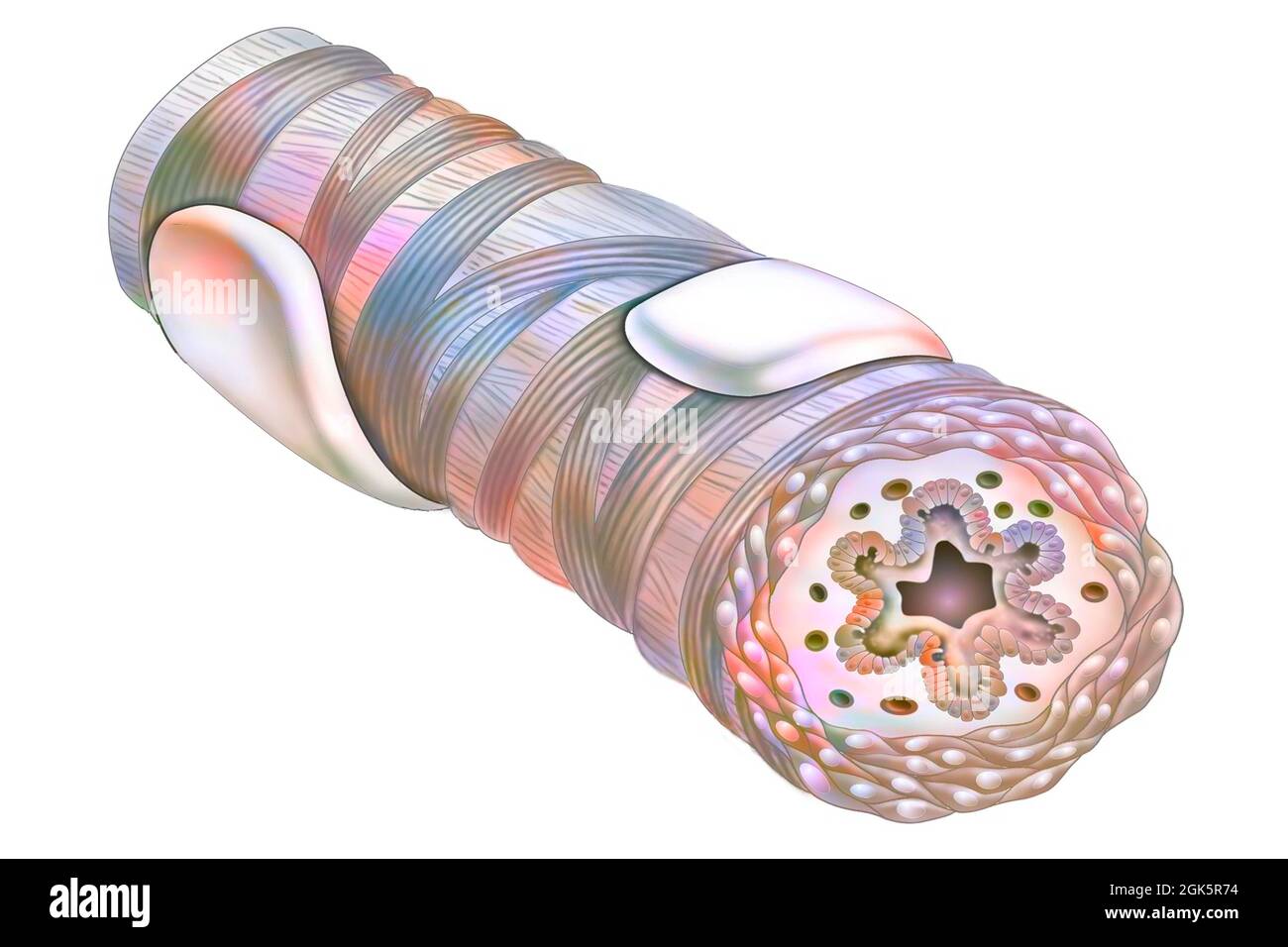 Bronchus of an asthmatic: wall of the bronchus thicker Stock Photo - Alamy