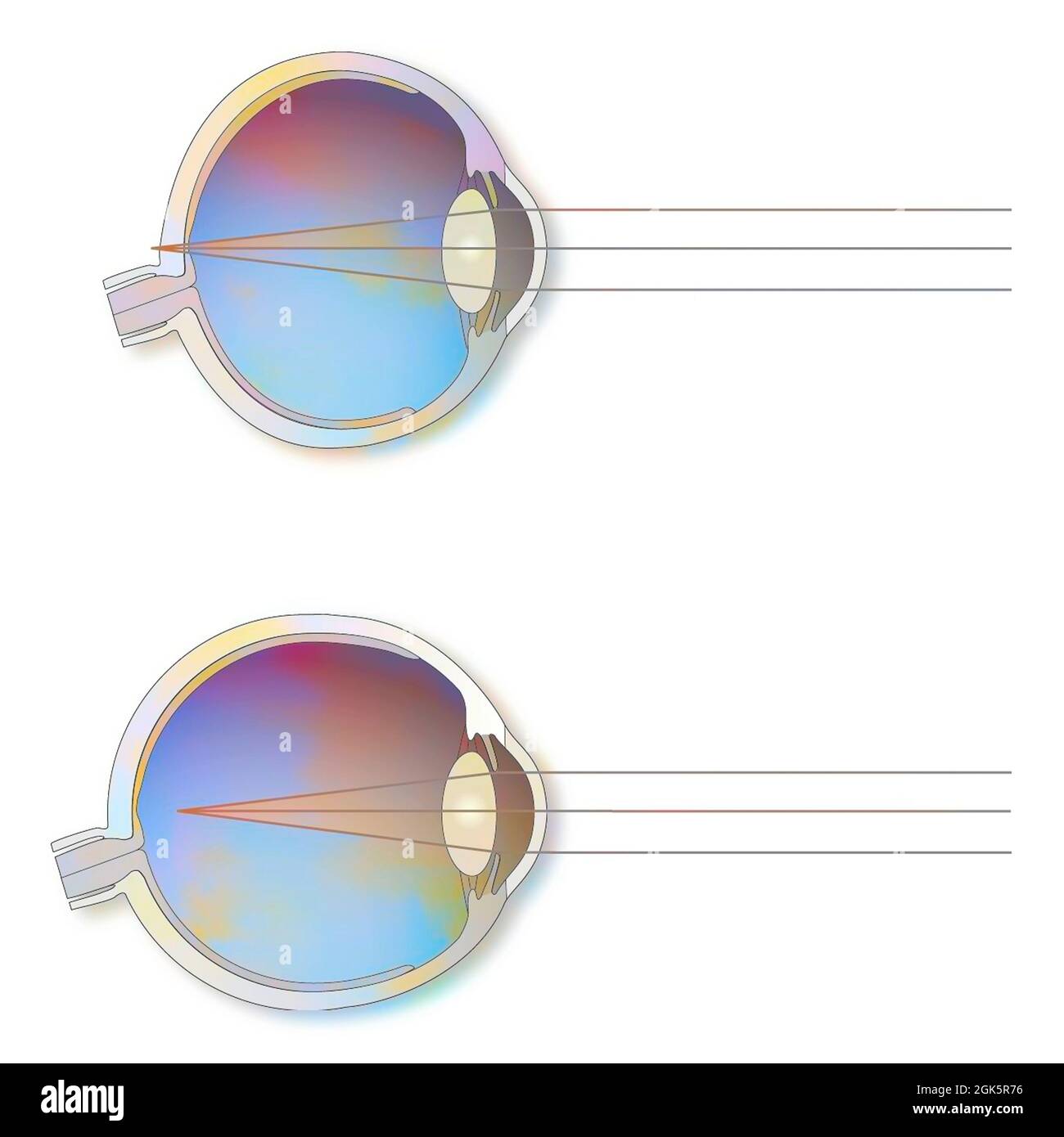 Myopia and hyperopia hi-res stock photography and images - Alamy