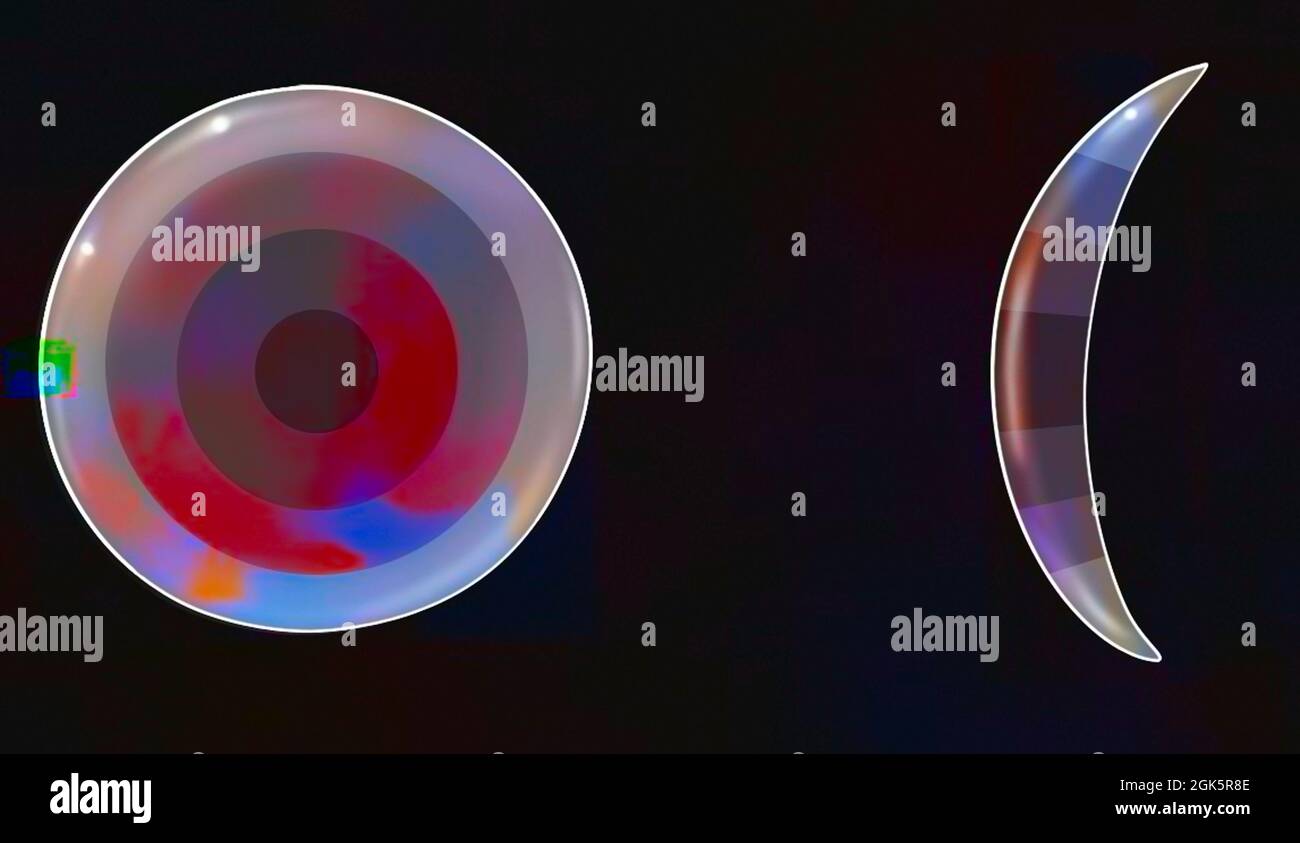 Correction of presbyopia: aspherical alternating vision contact lens ...