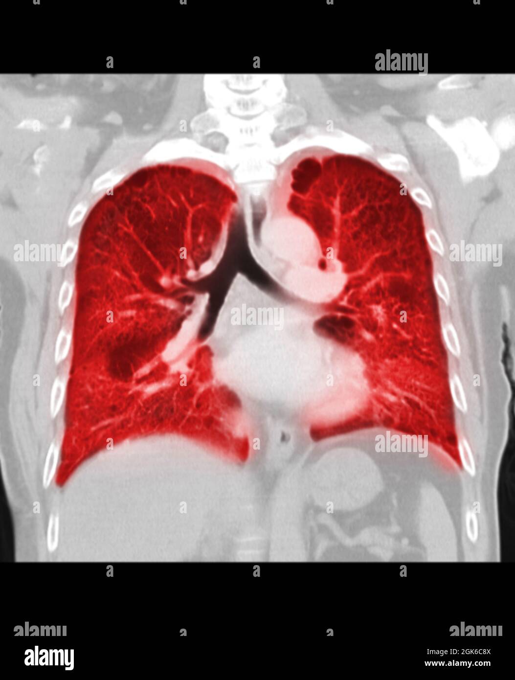 CT scan of Chest or lung coronal view of lung infection covid-19 with ...