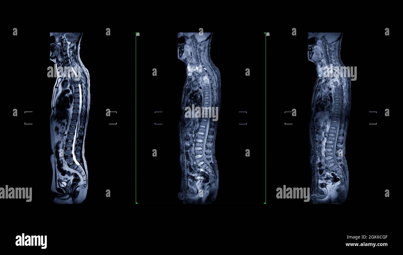 Thoracic vertebrae fracture hi-res stock photography and images - Alamy