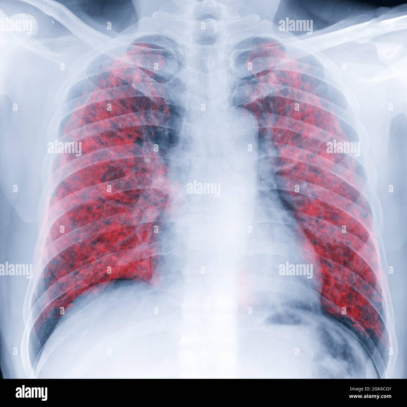 Chest X-ray Of Human Chest or Lung demonstrate lung after detect corona ...