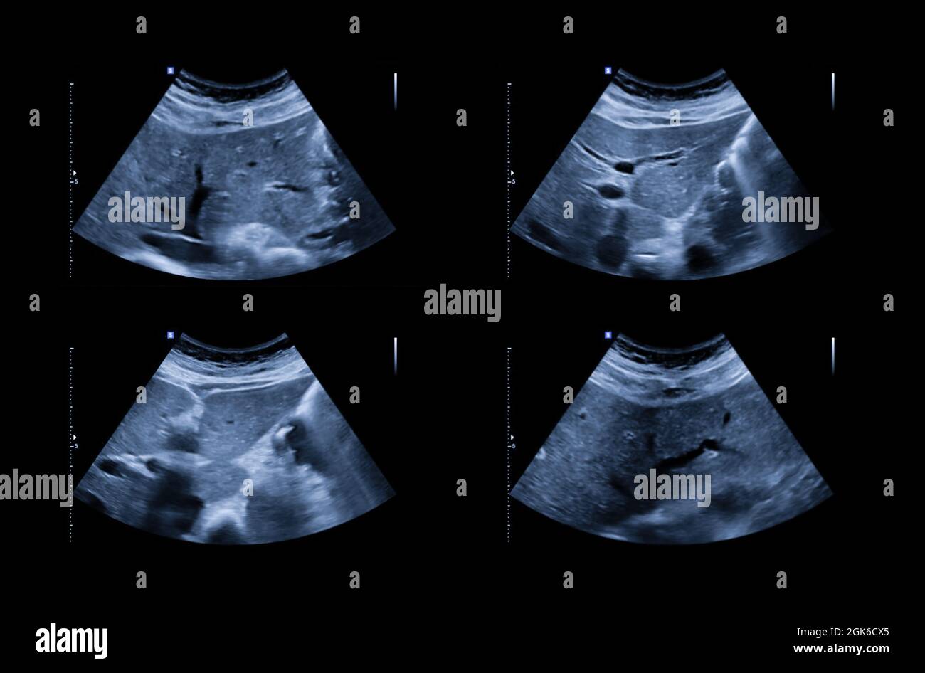 Gallbladder Anatomy Ultrasound