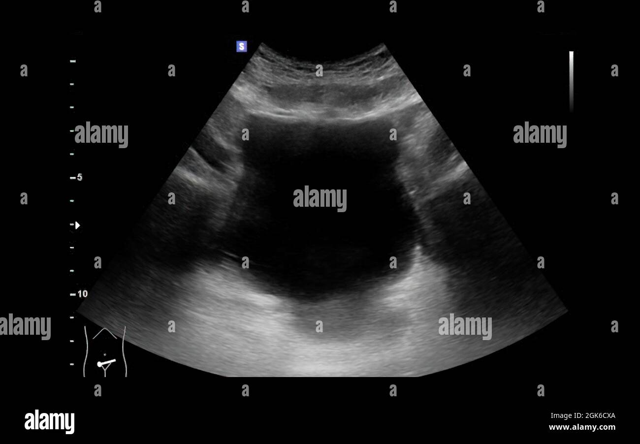 Ultrasound of urinary bladder or KUB for screening renal and bladder ...