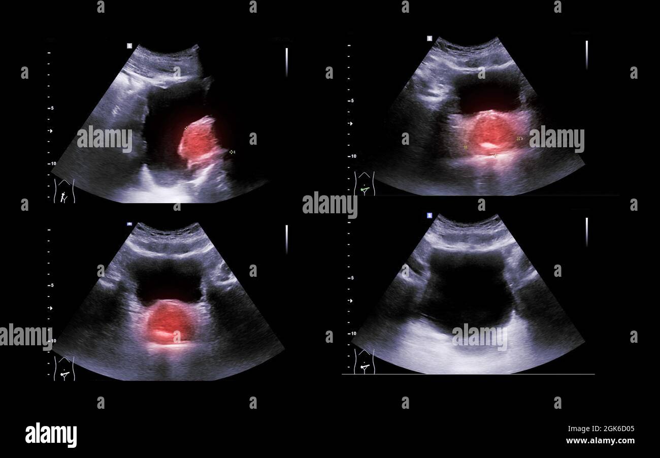 Ultrasound of urinary bladder or KUB for screening renal and bladder ...