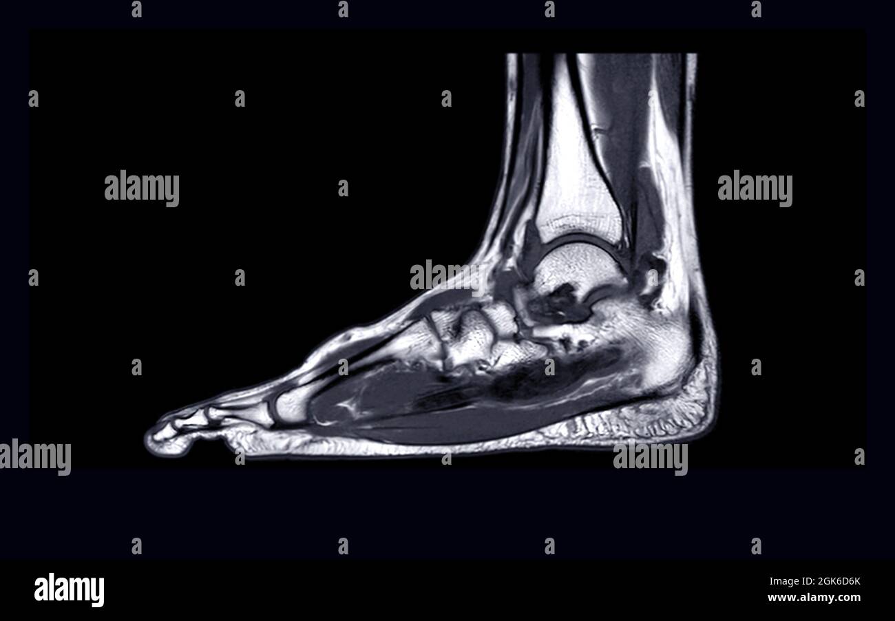 MRI FOOT Sagittal T2 for diagnostic tendon injury Stock Photo - Alamy