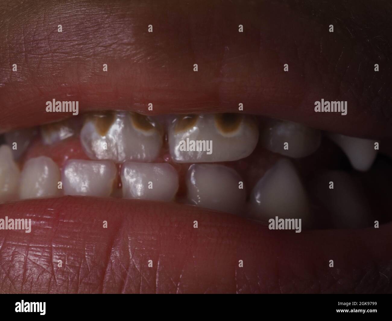 Pictures of kid's rotten teeth that usually caused by Poor dental ...