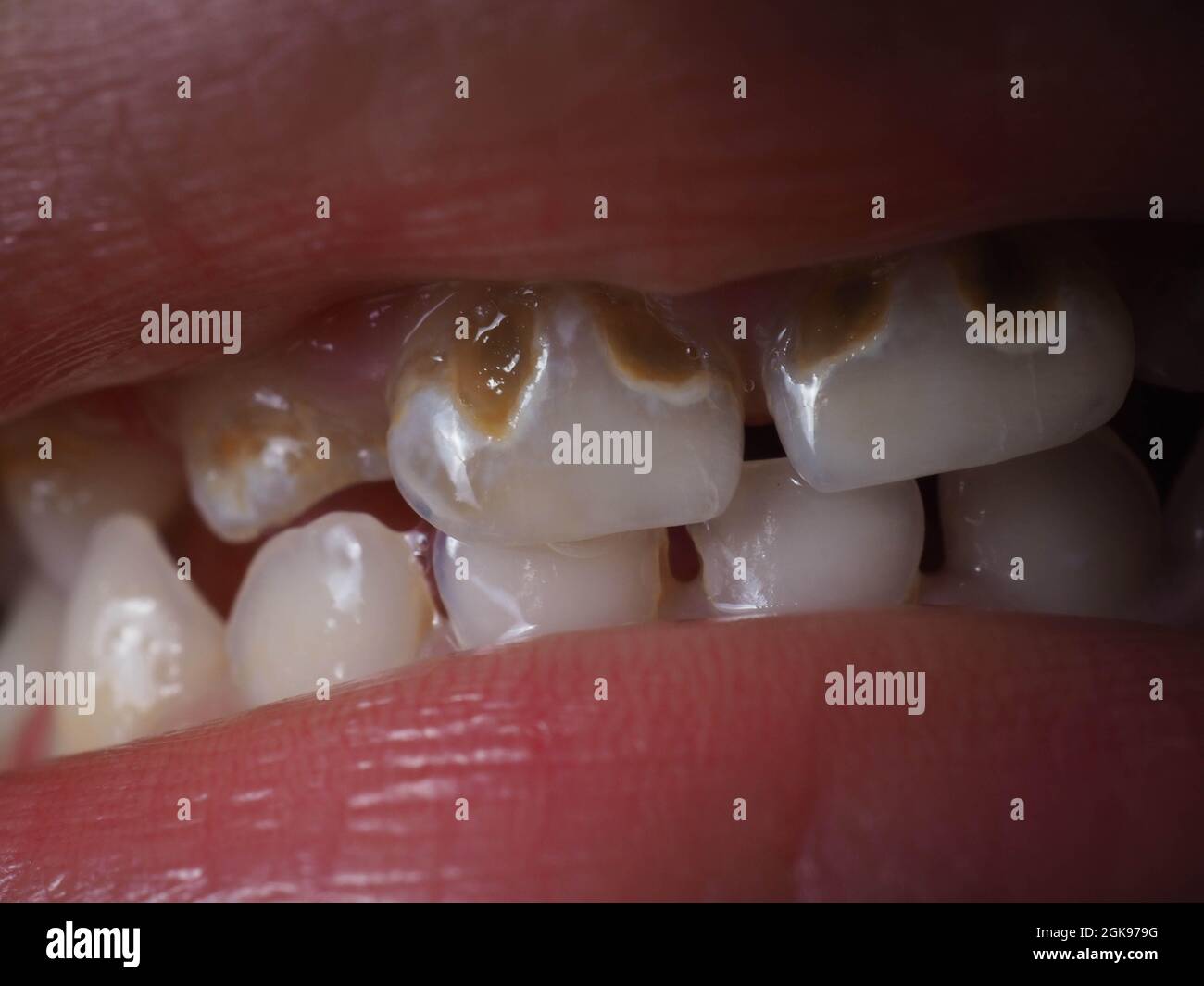 Pictures of kid's rotten teeth that usually caused by Poor dental ...