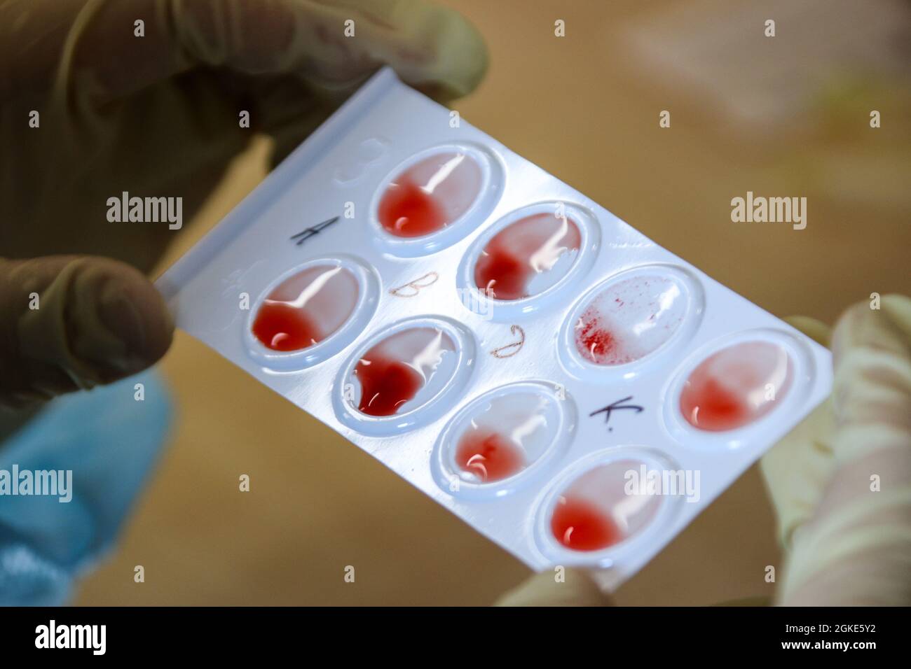 Blood group determination Stock Photo - Alamy
