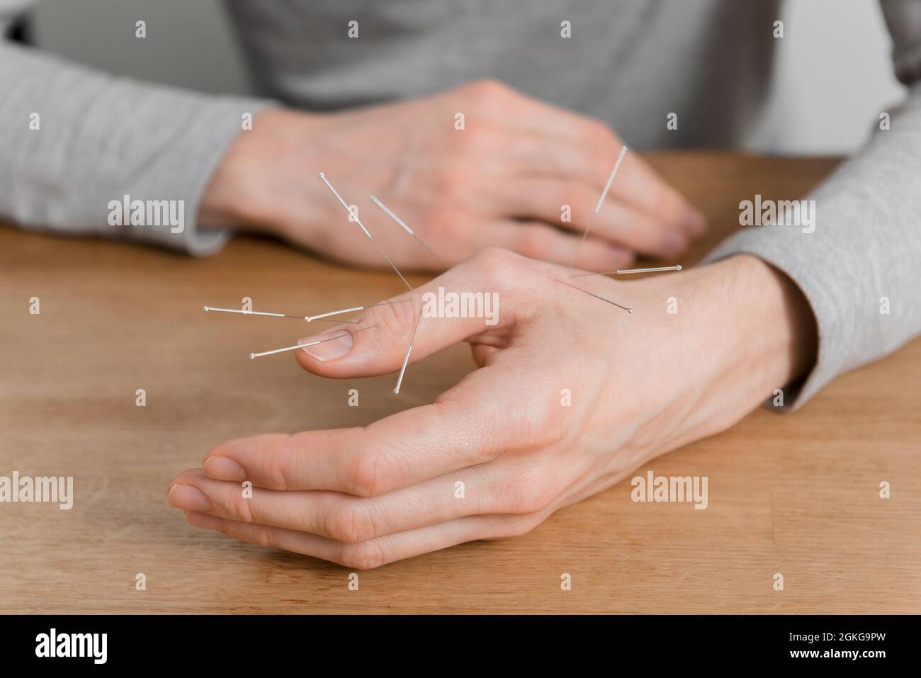 Man using acupuncture treatment for pain relief. Chinese alternative ...