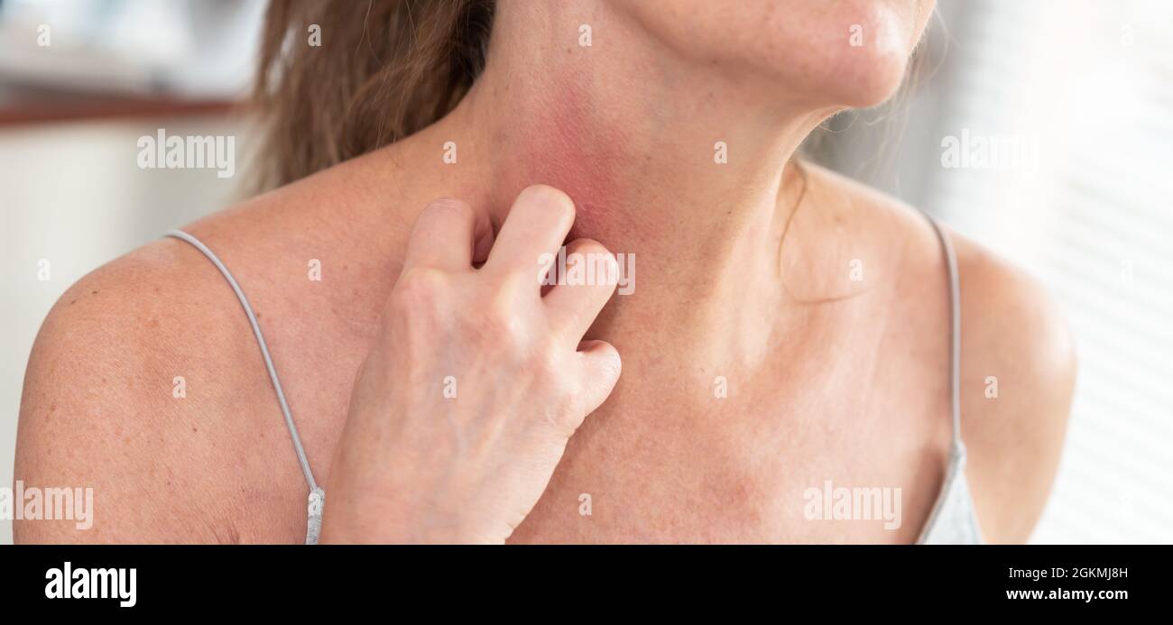 Woman having itchy and scratching her neck. Allergy symptoms Stock Photo - Alamy