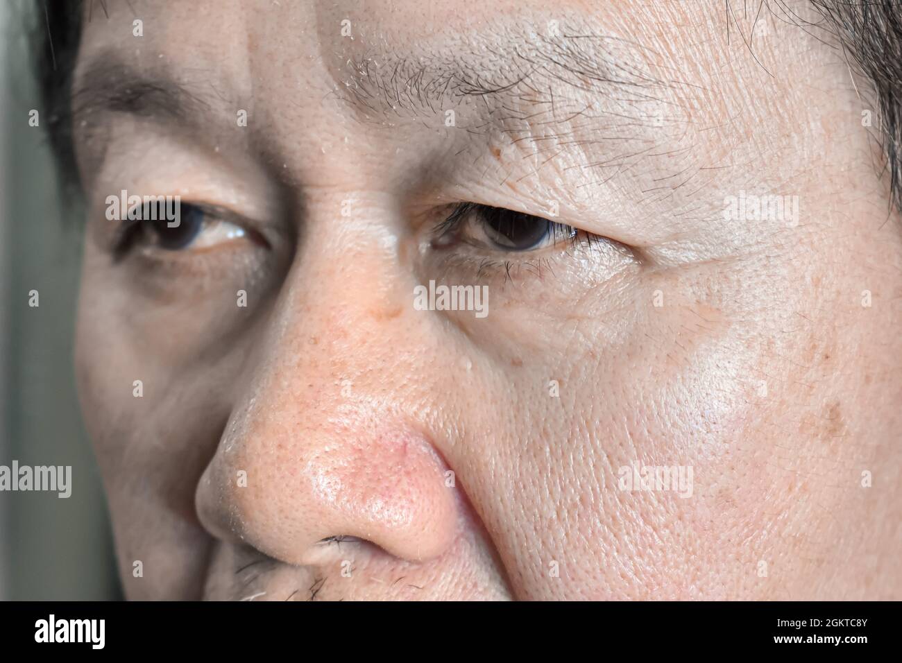 Skin tear senior hi-res stock photography and images - Alamy