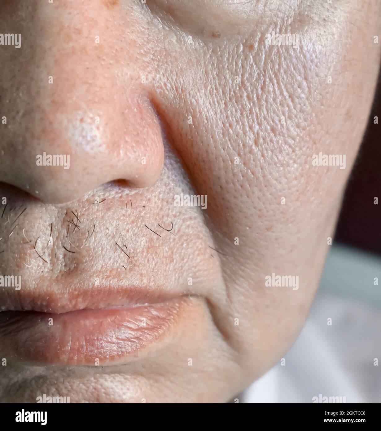 Enlarged pores in face of Southeast Asian, Chinese elder man with skin ...