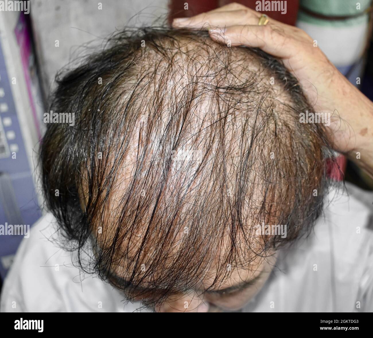 Sparse hair man hi-res stock photography and images - Alamy