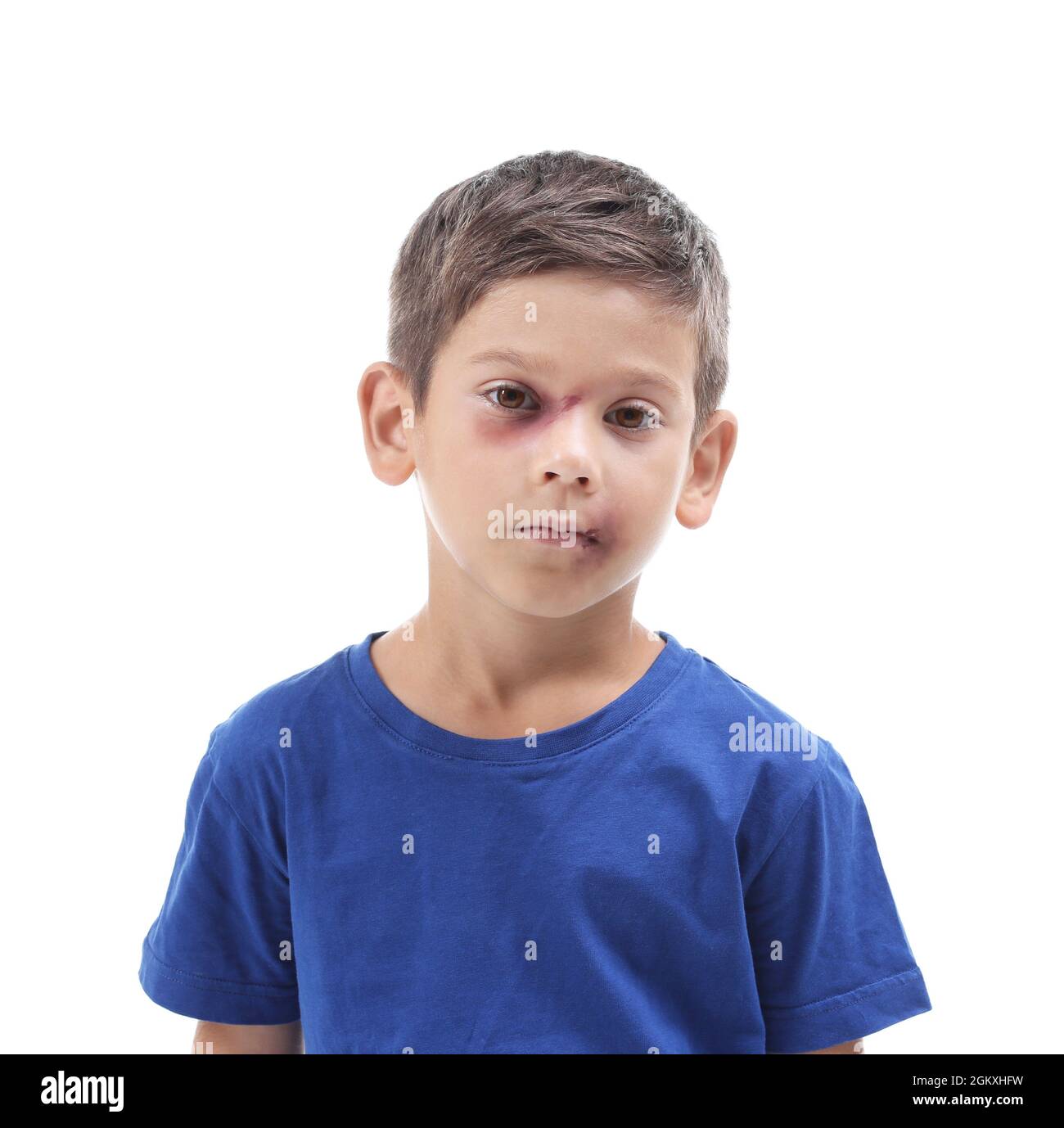 Boy bruises hi-res stock photography and images - Alamy