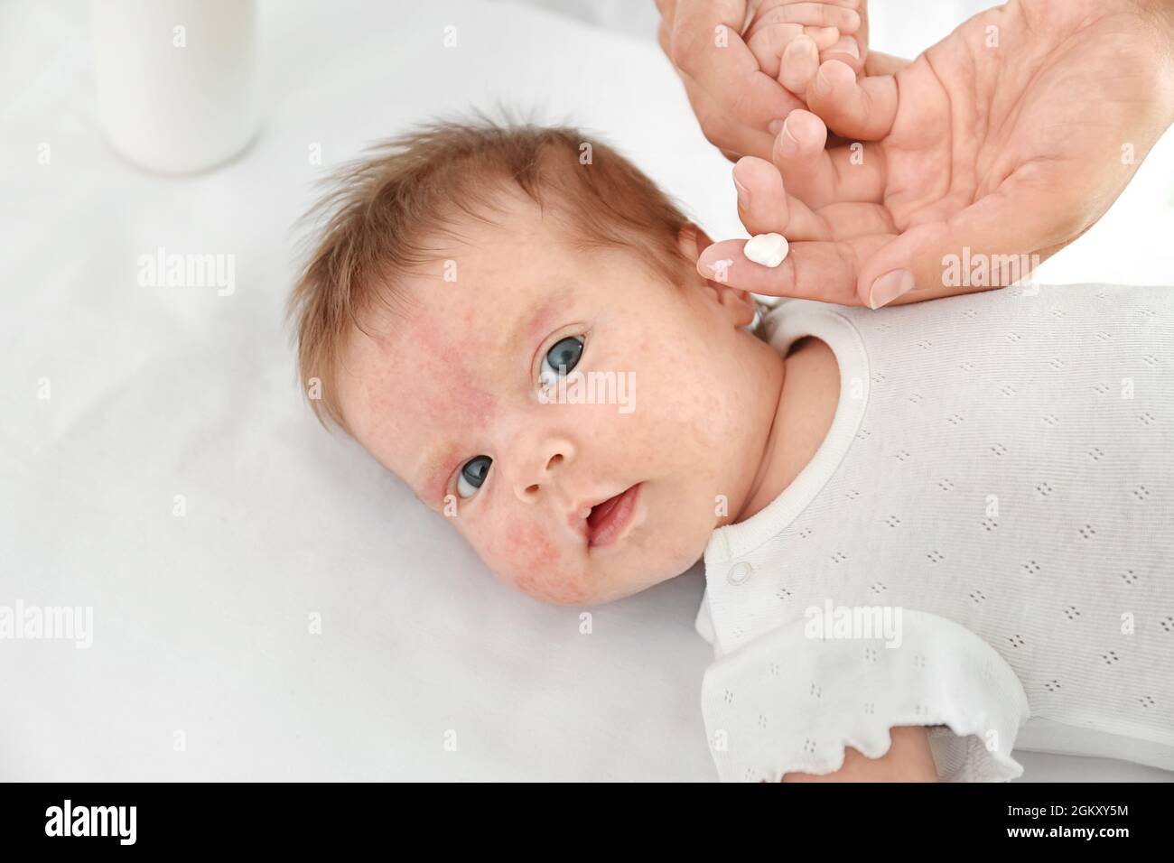 Adorable baby with skin allergy undergoing treatment in hospital Stock ...