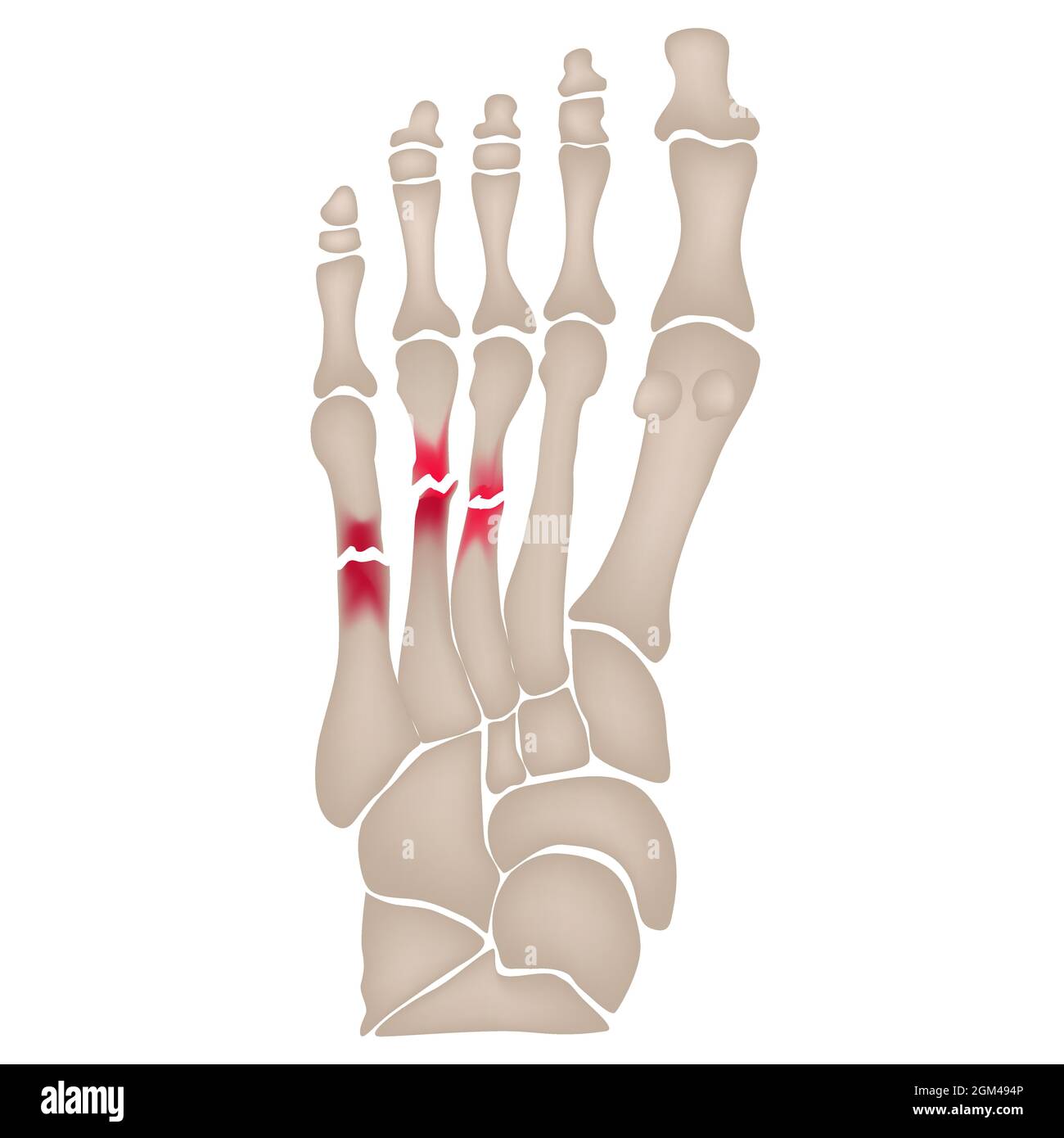Fracture of the metatarsal bones in the foot. Anatomical structure of ...