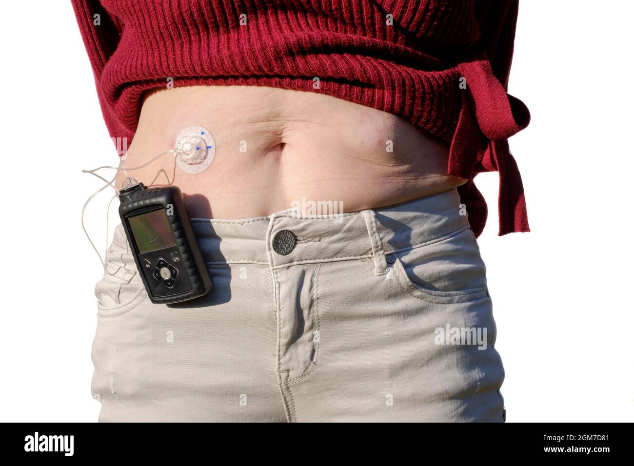 woman wearing a mobile medtronic insulin pump for her diabetes Stock ...