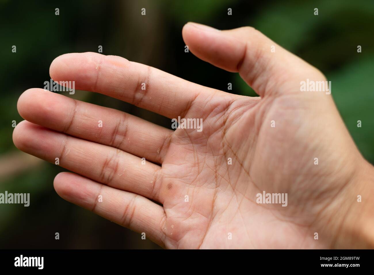 Blister on palm of hand hi-res stock photography and images - Alamy