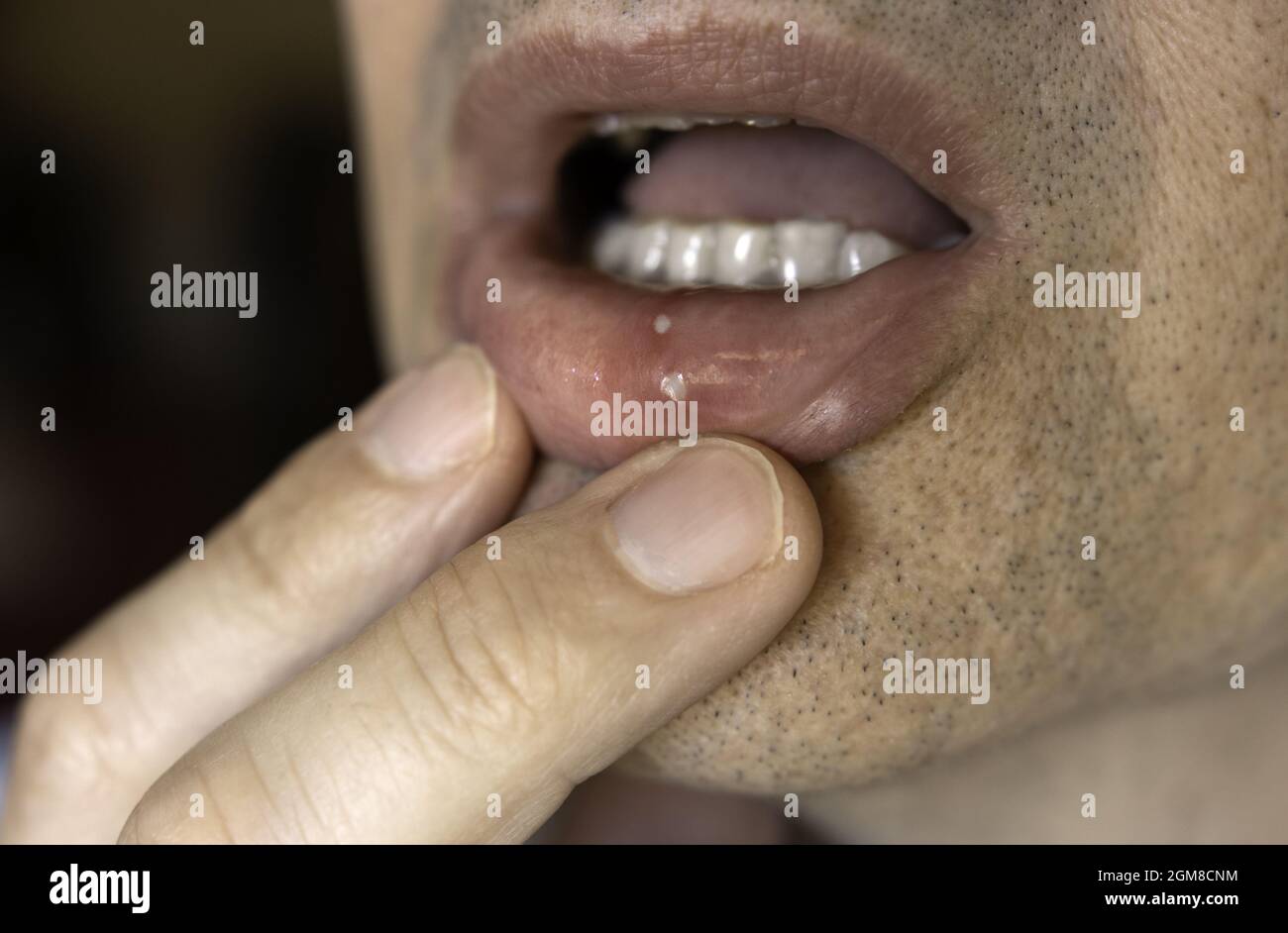 Recurrent Aphthous Stomatitis