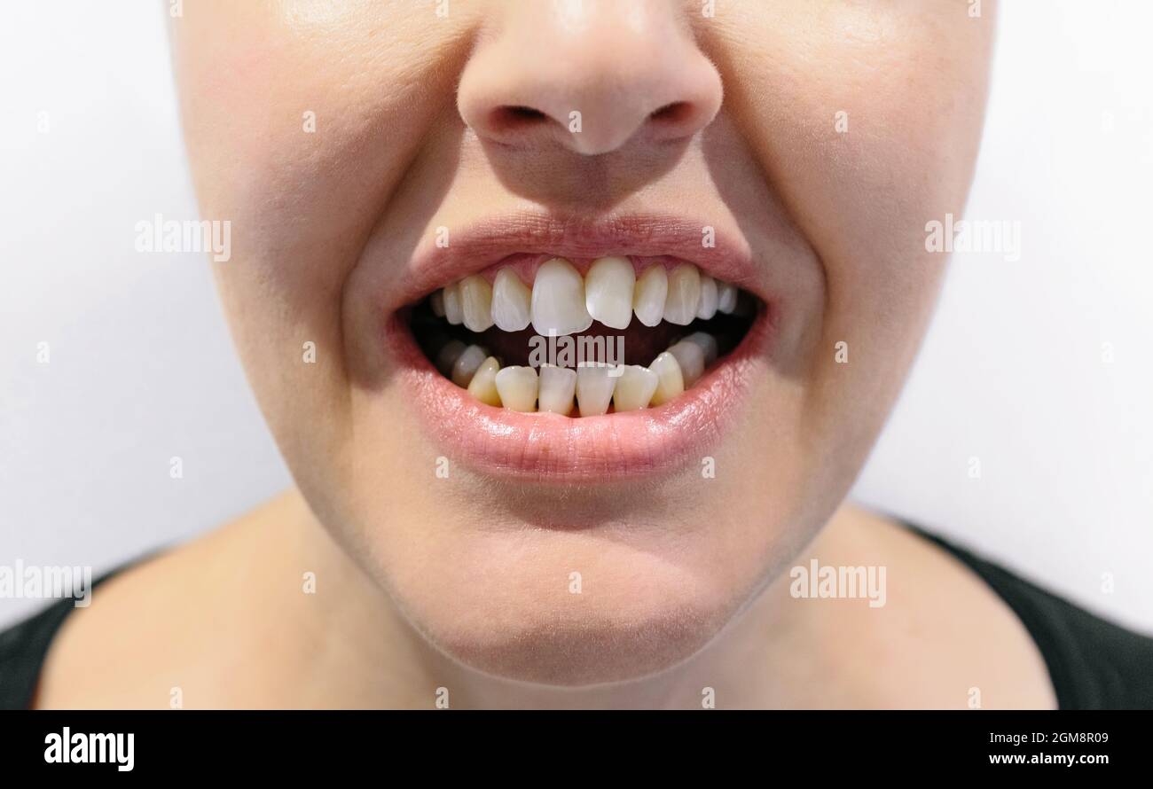 Woman open mouth and teeth hi-res stock photography and images - Alamy