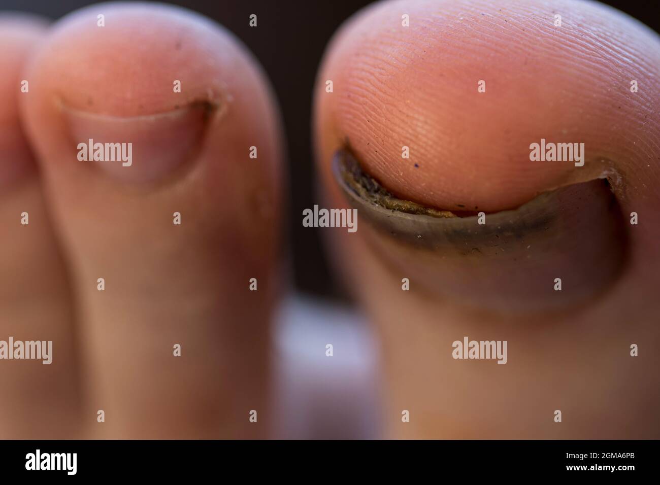 Damaged nail foot health. Big toe nail infected with nail fungus Stock ...