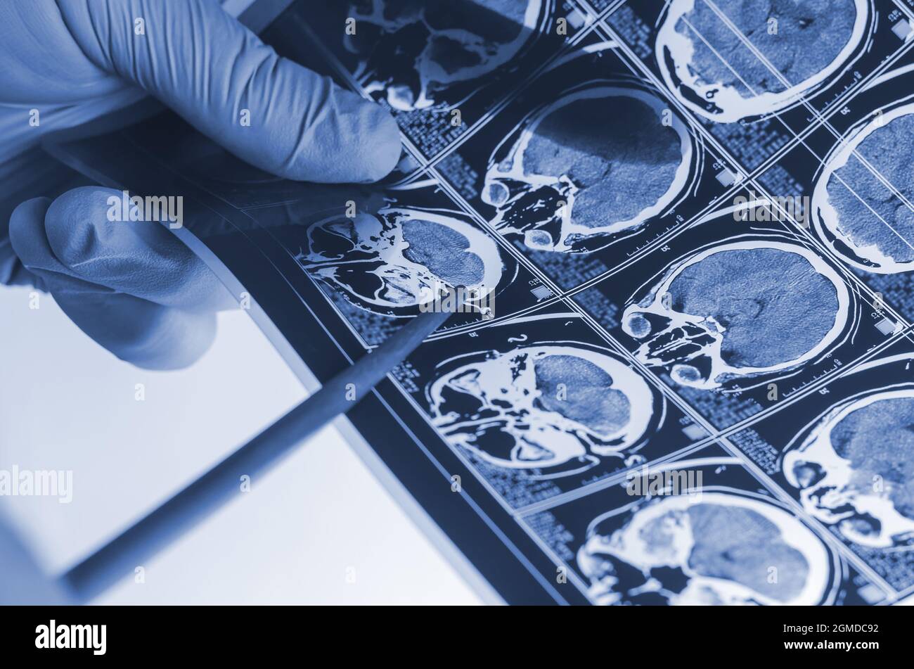 Close up of the mri scan of the human brain hi-res stock photography ...