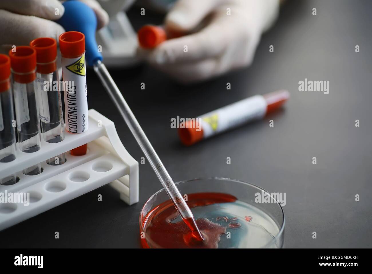 A blood sample for testing the dangerous virus coronavirus in body ...
