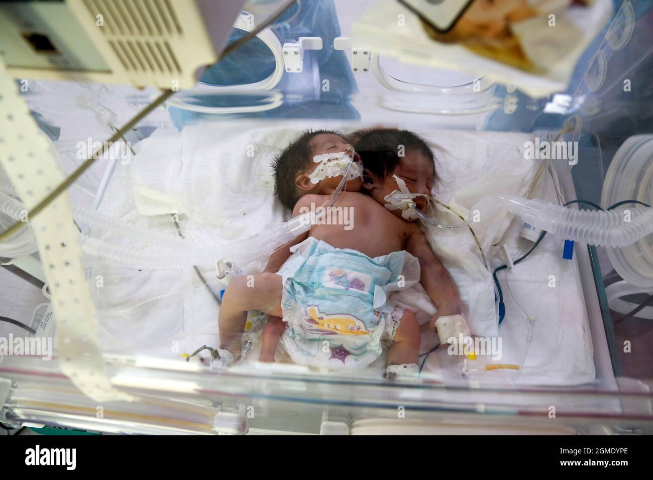 Conjoined twins born hi-res stock photography and images - Alamy