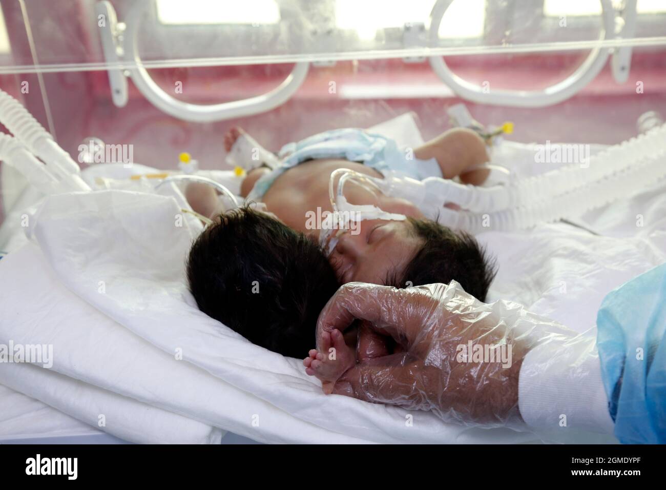Sanaa, Yemen. 17th Sep, 2021. A nurse checks newly-born conjoined twins ...