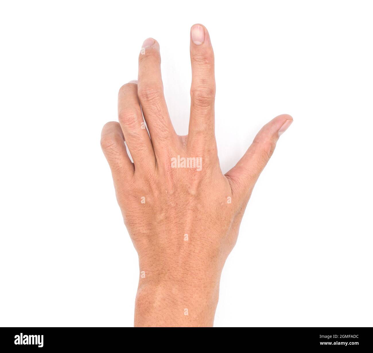 Dupuytren’s contracture in left hand of Asian young man. It is a ...