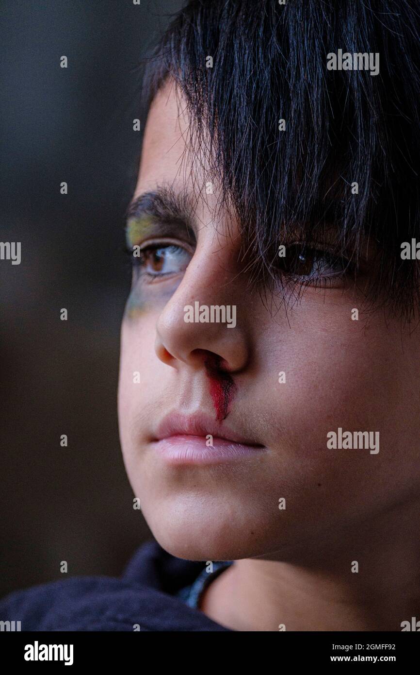 Boy bleeding nose hi-res stock photography and images - Alamy