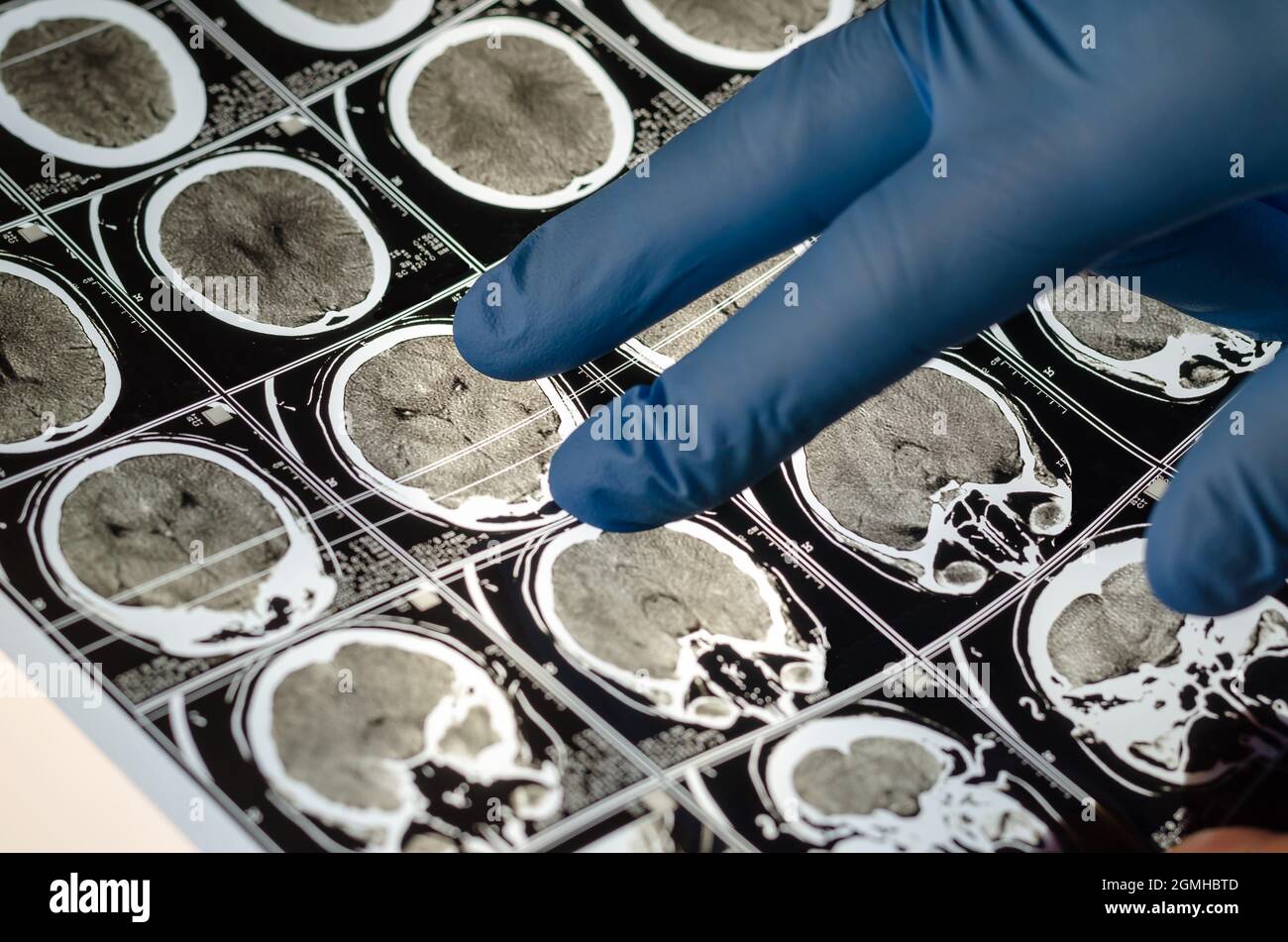 Brai surgery hi-res stock photography and images - Alamy