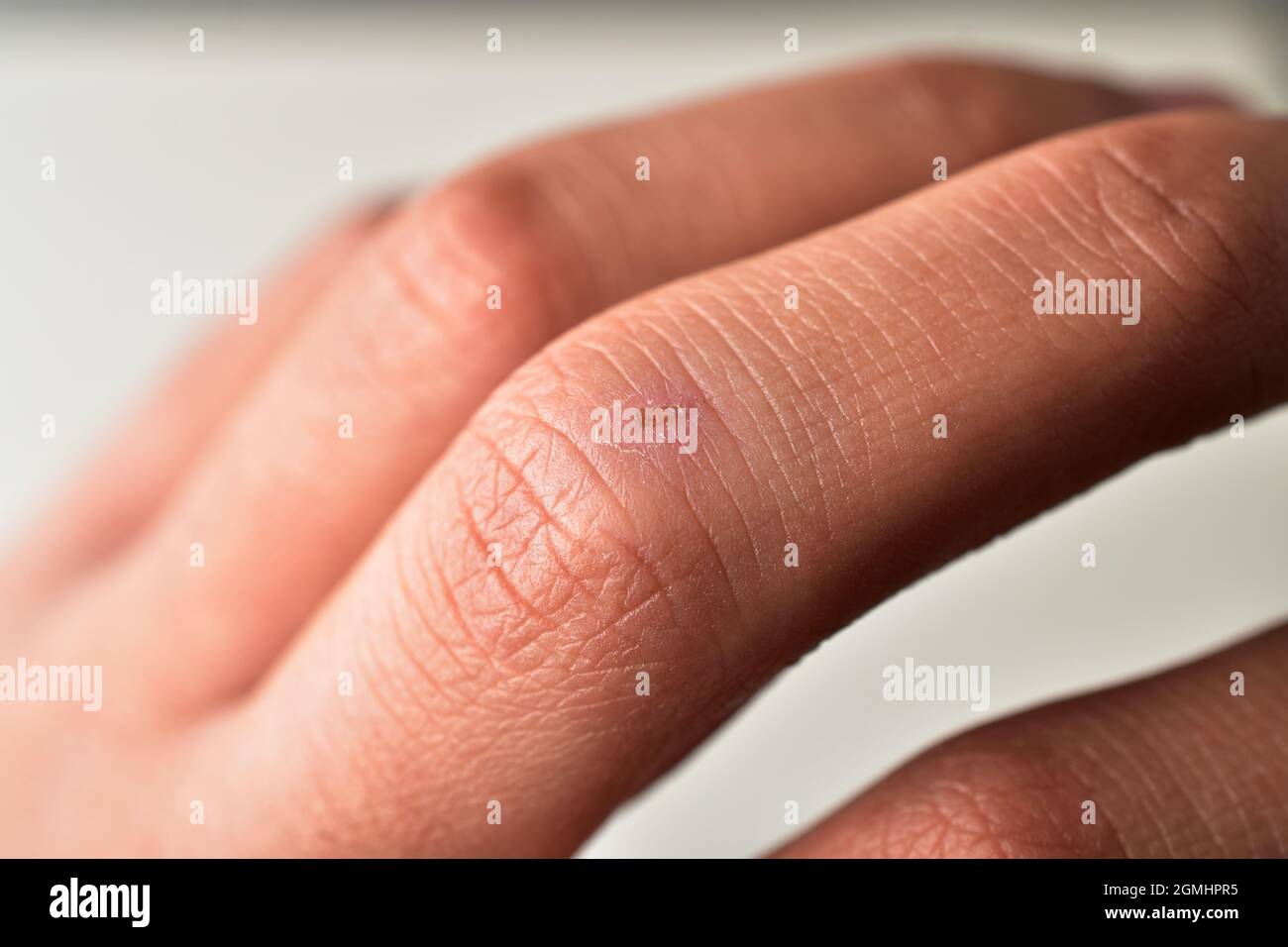 Tiny Wound on Finger Stock Photo - Alamy