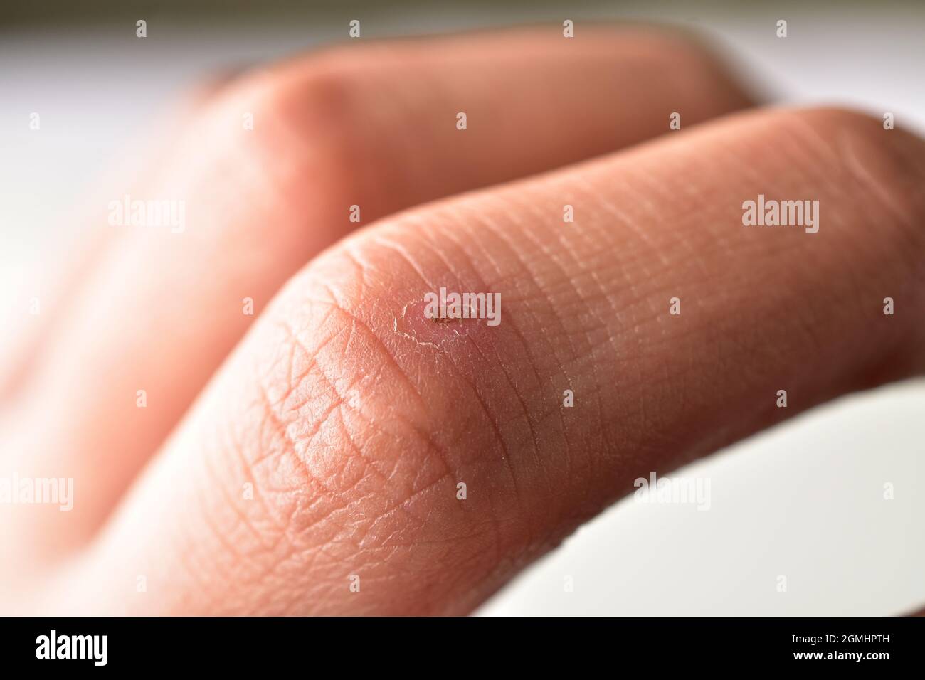 Tiny Wound on Finger Stock Photo - Alamy