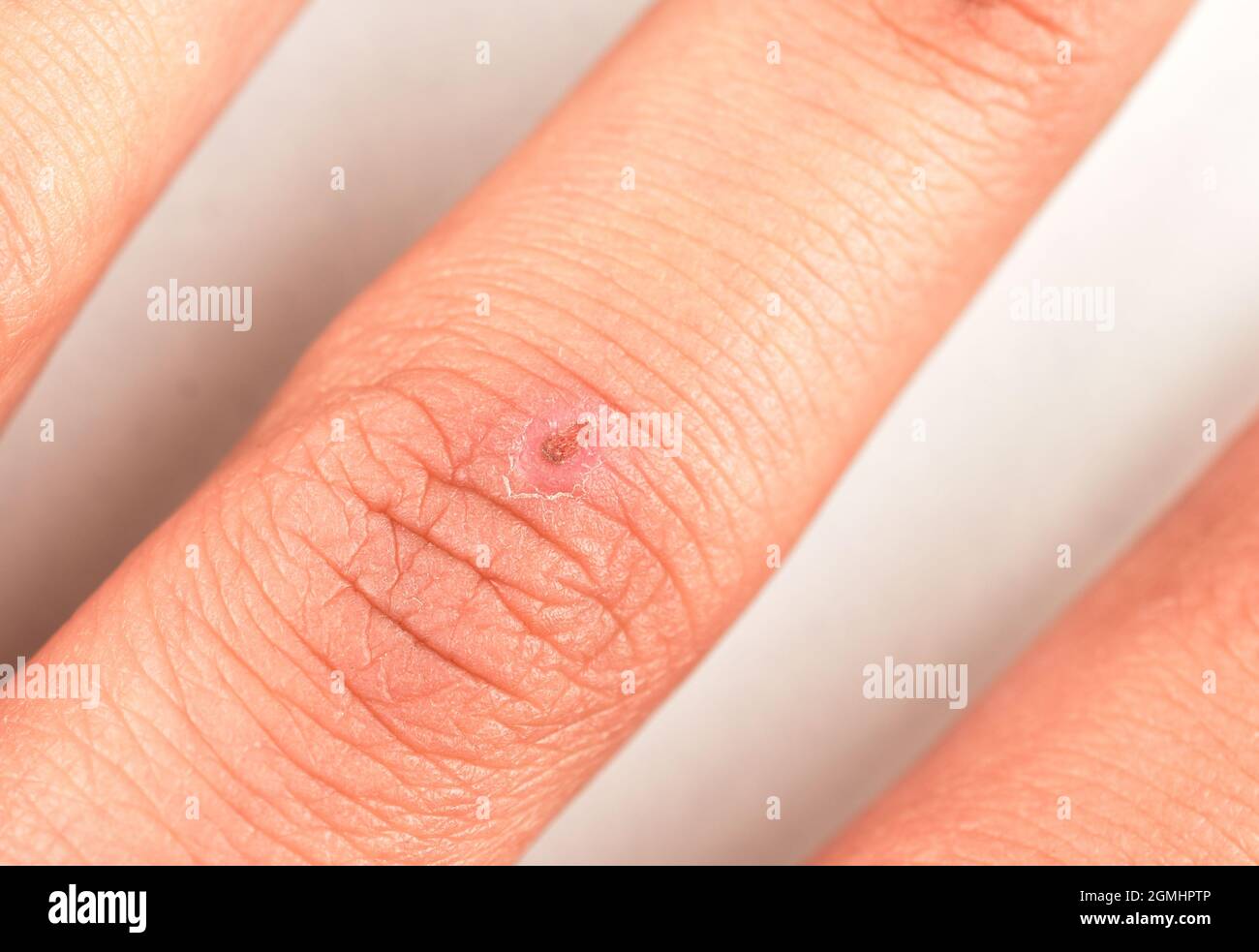 Wound hand hi-res stock photography and images - Alamy