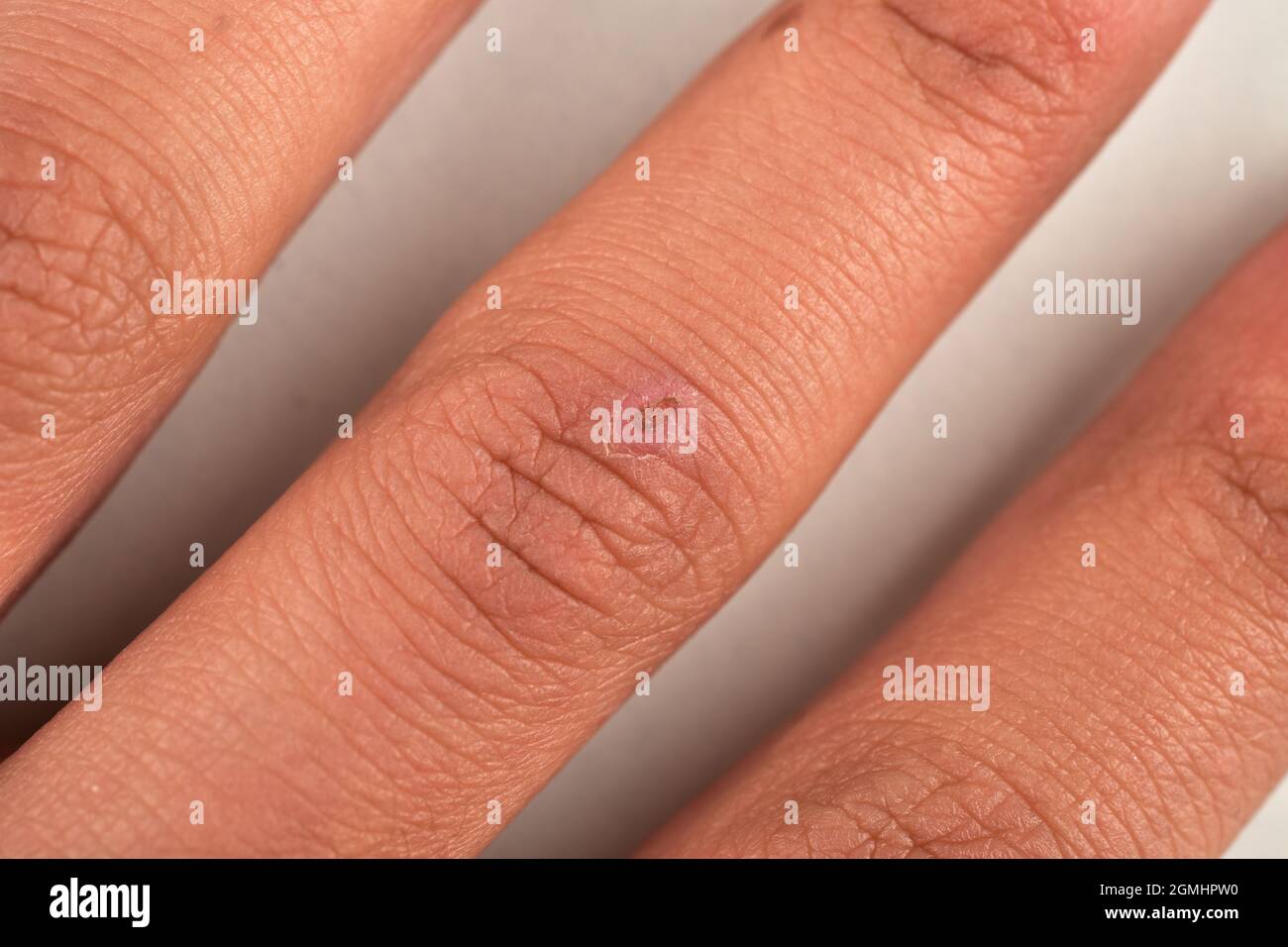 Tiny Wound on Finger Stock Photo - Alamy