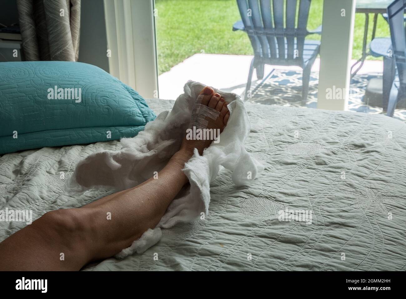 Cast removed from a foot after bunion surgery as the leg is elevated ...